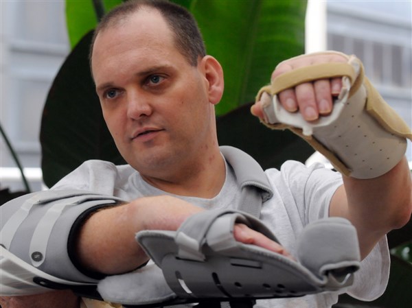 Pennsylvanian becomes trailblazer in hand transplants | The Blade