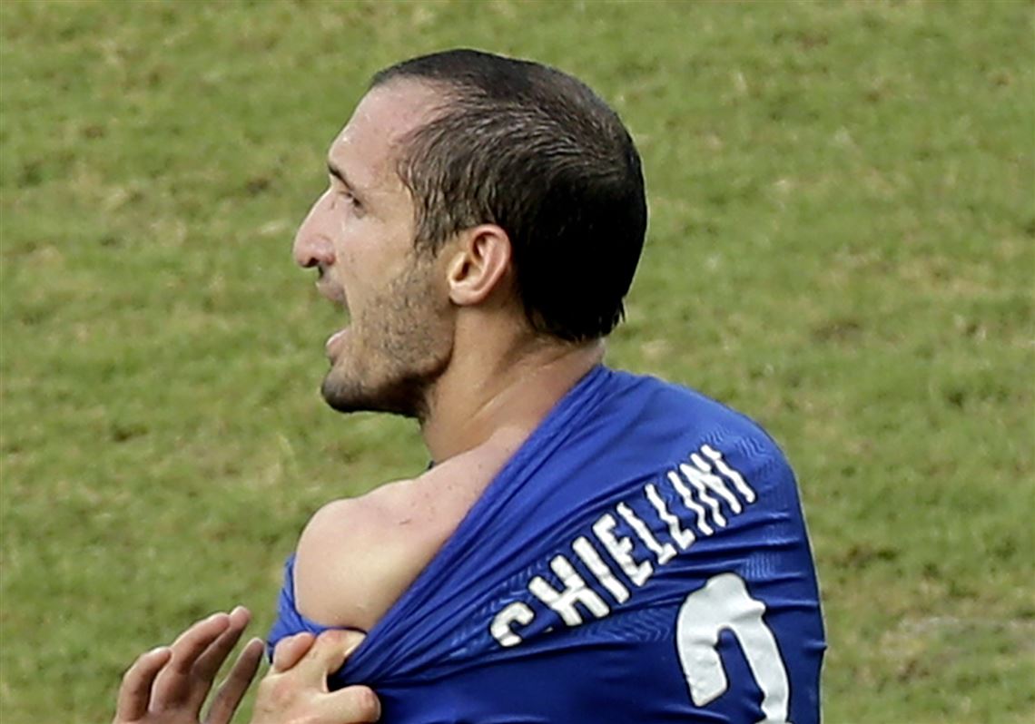 Luis Suarez Buck Teeth