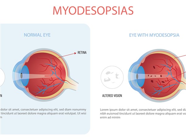 Eye floaters come with age and serve as cause for vigilance in optic ...