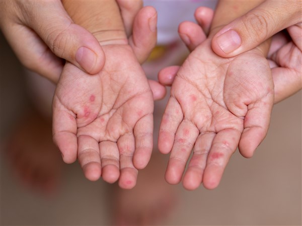 Hand, foot, and mouth disease: The inevitable scourge of daycare | The ...