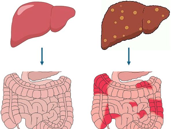 UT researcher investigates link between liver disease and inflammatory ...