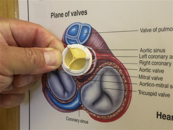 Toledo native first in world to receive innovative new heart valve ...